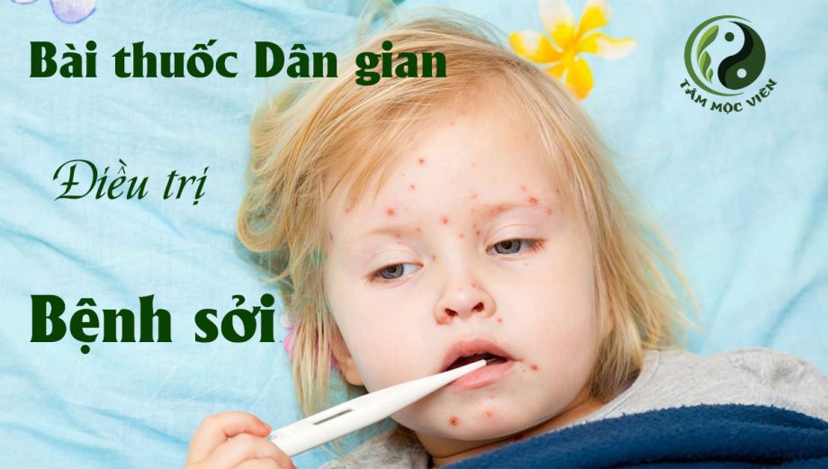 Trị bệnh sởi bằng bài thuốc dân gian - Tuệ Y Đường