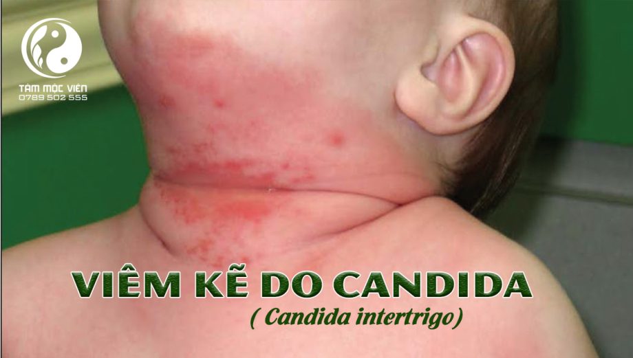 Viêm kẽ do Candida ( Candida intertrigo) - Tuệ Y Đường