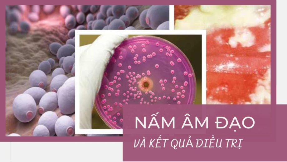 NẤM ÂM ĐẠO - VÀ KẾT QUẢ ĐIỀU TRỊ - Tuệ Y Đường0