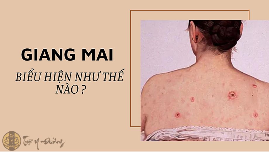 GIANG MAI BIỂU HIỆN NHƯ THẾ NÀO ? - Tuệ Y Đường0