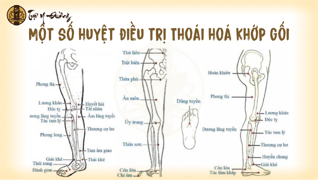 3 thể thoái hóa khớp gối theo YHCT và cách châm cứu? - Tuệ Y Đường